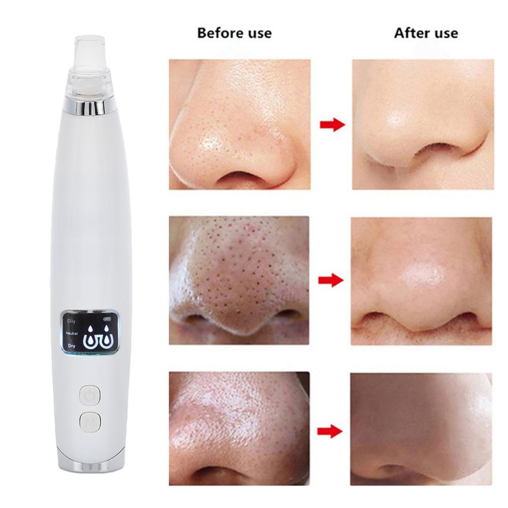 Remove Blackhead Clear Black Head Cleaner Blackhea... – Vicedeal