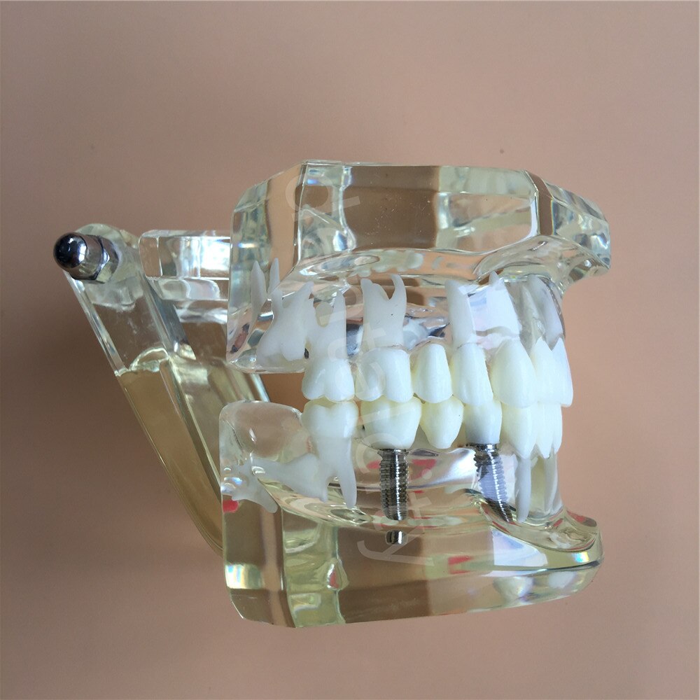 Dental Implant Disease Teeth Model With Restoratio... – Grandado
