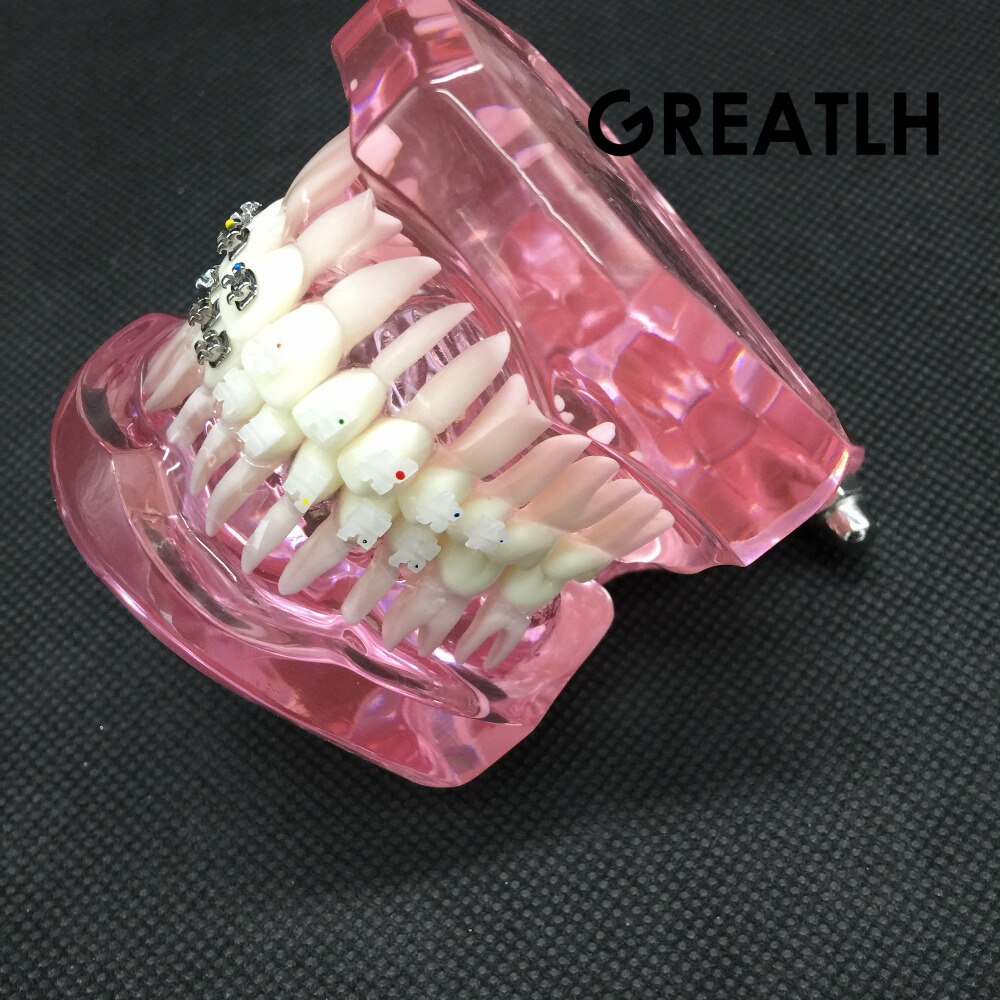 Dental Orthodontic Model with Metal and Ceramic Br... – Vicedeal