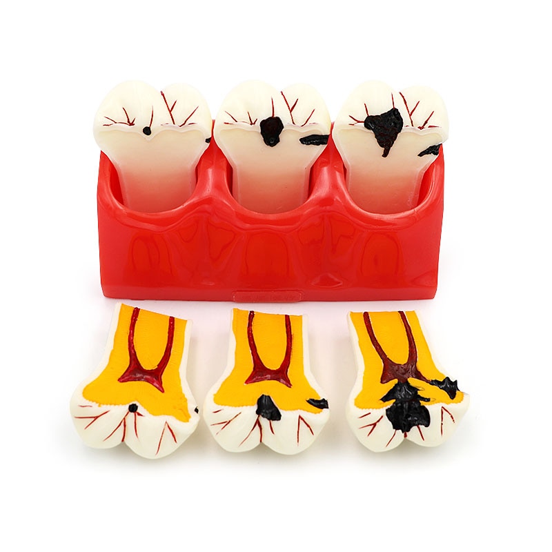 Dental Decayed Teeth Model Denture Caries Disease ... – Vicedeal