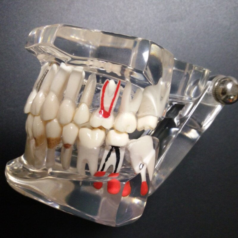 Clear Transparent Dental Implant Disease Caries Te... – Vicedeal