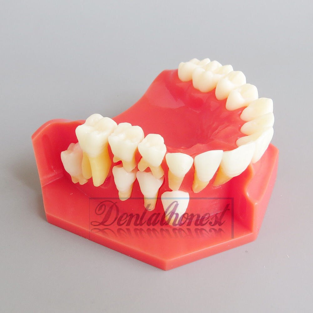 Dental Model #4006 01 - Teeth Eruption Development... – Vicedeal