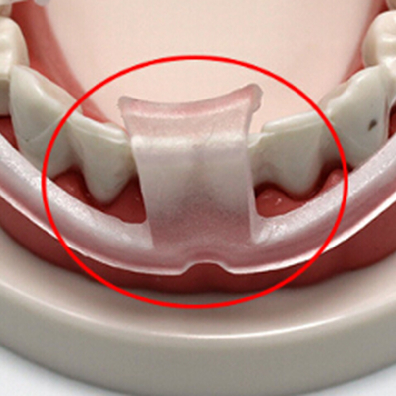 Teeth EVA Orthodontic Braces Appliance Alignment T... – Grandado