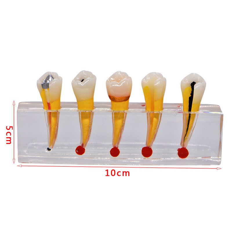 Dental Pulp Restoration Pathological Model with De... – Vicedeal