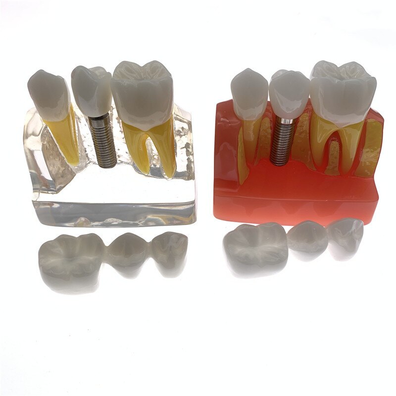 Dental 4 times planting Teeth model Analysis Crown... – Vicedeal