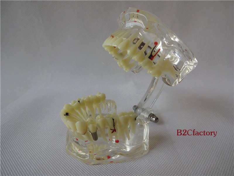Dental Study Tooth Model Adult Pathological& D... – Vicedeal
