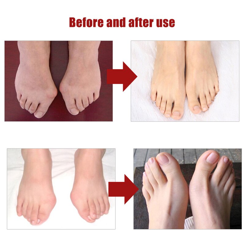 1Pair Silicone Foot Bone Thumb Toe Separators Heal... – Grandado