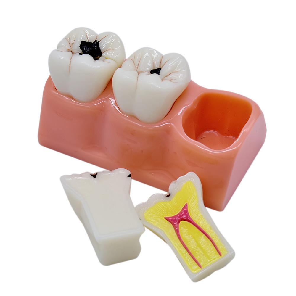 Dental teaching Model patien communication Dissect... – Vicedeal