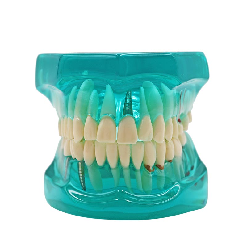 1 Piece Dental Teeth Model Dental Disease Teeth Im... – Grandado