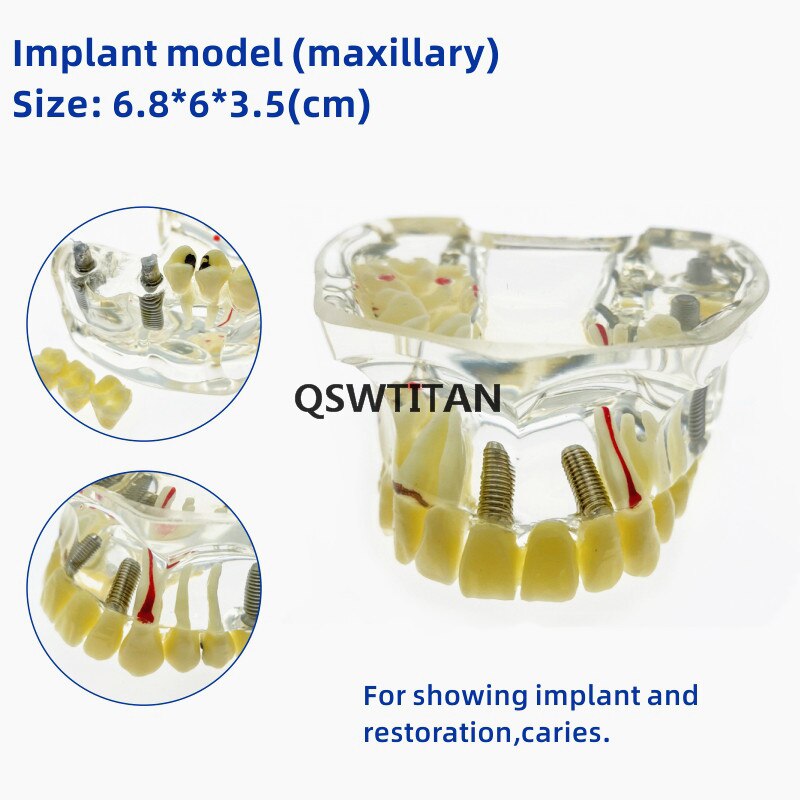 Dental Implant Upper Jaw Model With Bridge & C... – Vicedeal