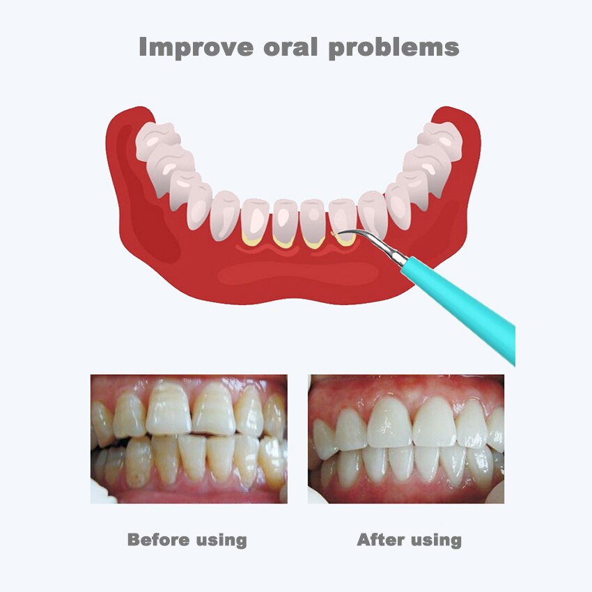 Electric Ultrasonic Dental Scaler Sonic Tooth Calc... – Vicedeal