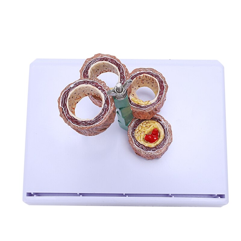 Atherosclerosis Thrombosis Model Vascular Disease ... – Grandado