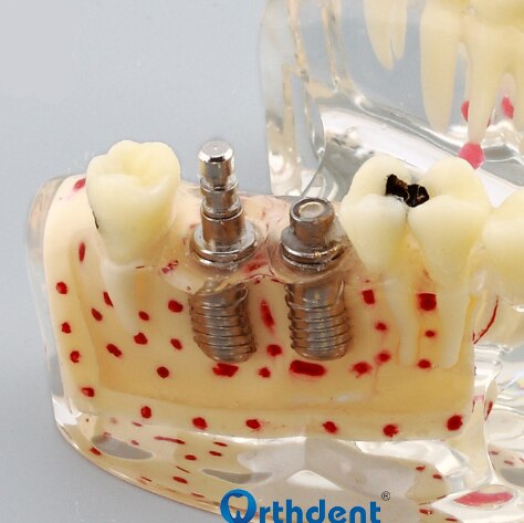 Dental Implant Teeth Model Demo Overdenture Restor... – Grandado