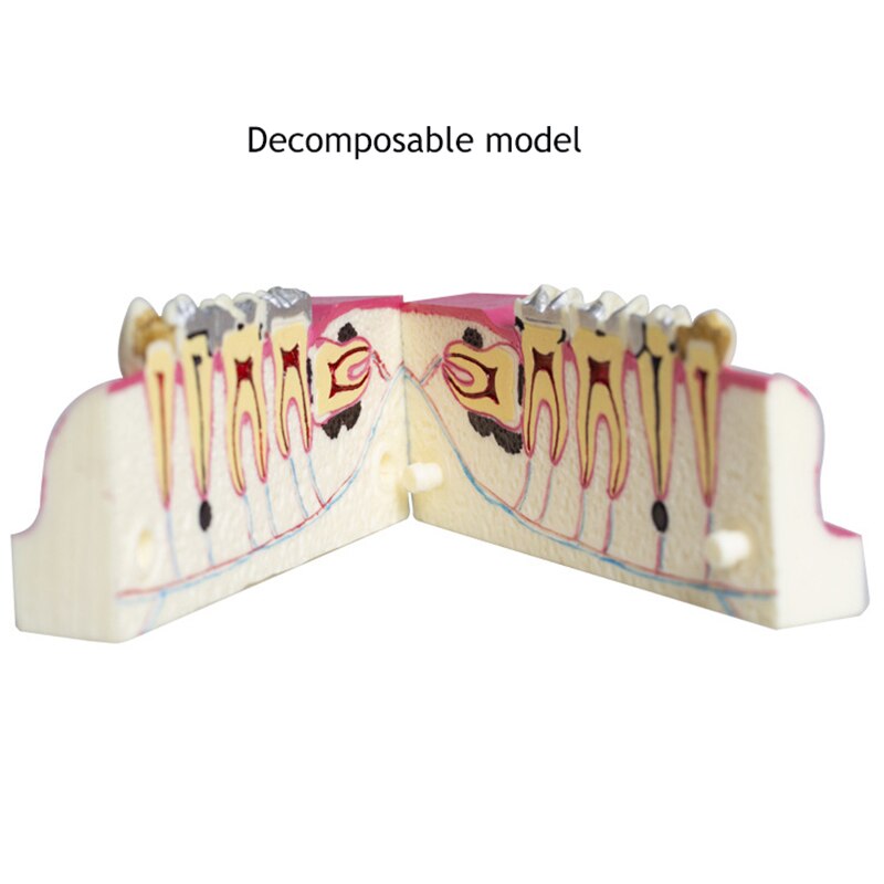 Right Lower Tooth Decomposition Model Molar Cross ... – Grandado