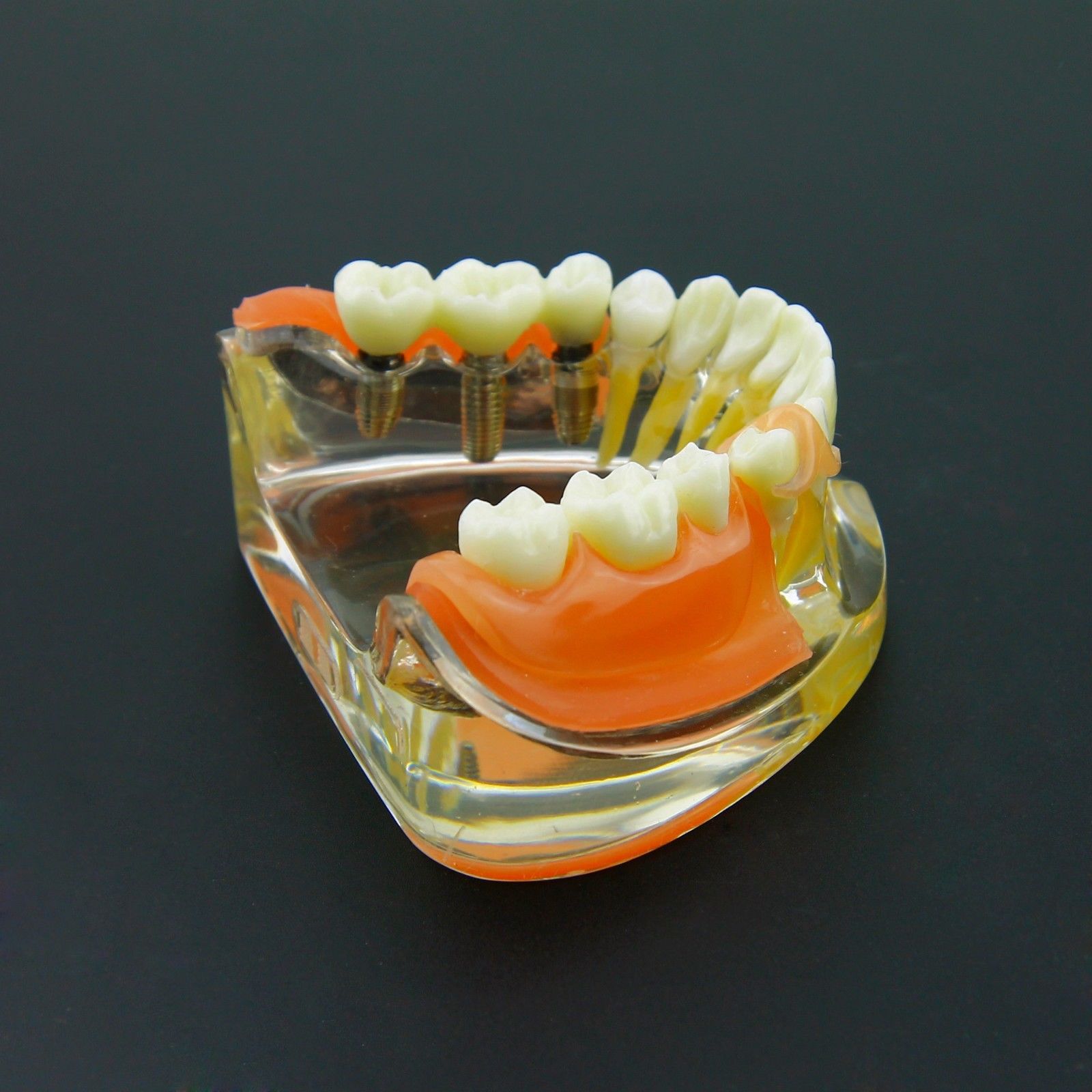 Dental Implant Restoration Teeth Model Removable B... – Vicedeal