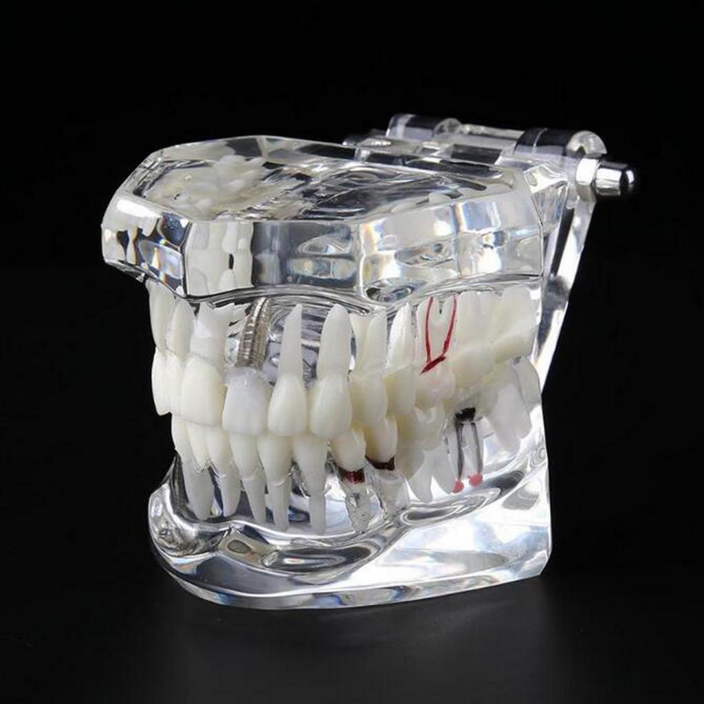 1pc Transparent Study Teeth Model with Nerve Repai... – Grandado