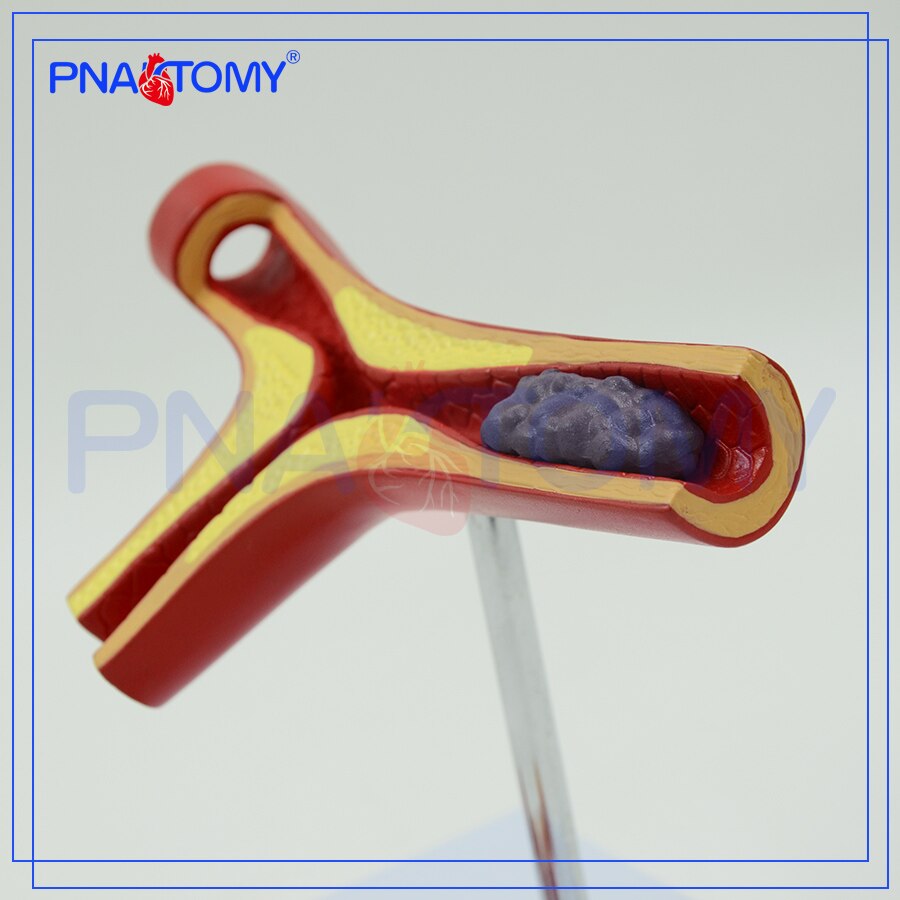 Arteriosclerose Model Met Trombus Voor Menselijk S... – Vicedeal
