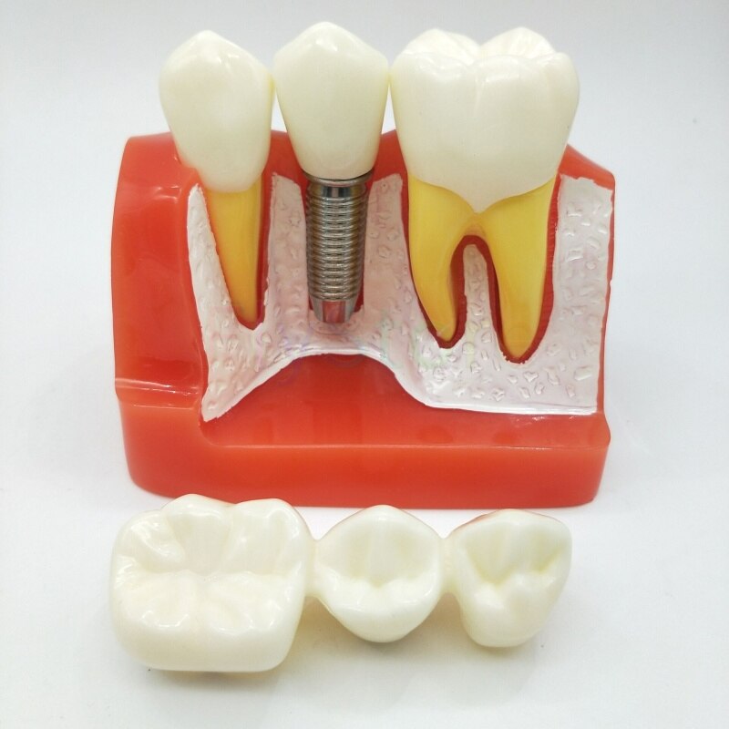 1pc dental demonstration teeth Removable model imp... – Grandado
