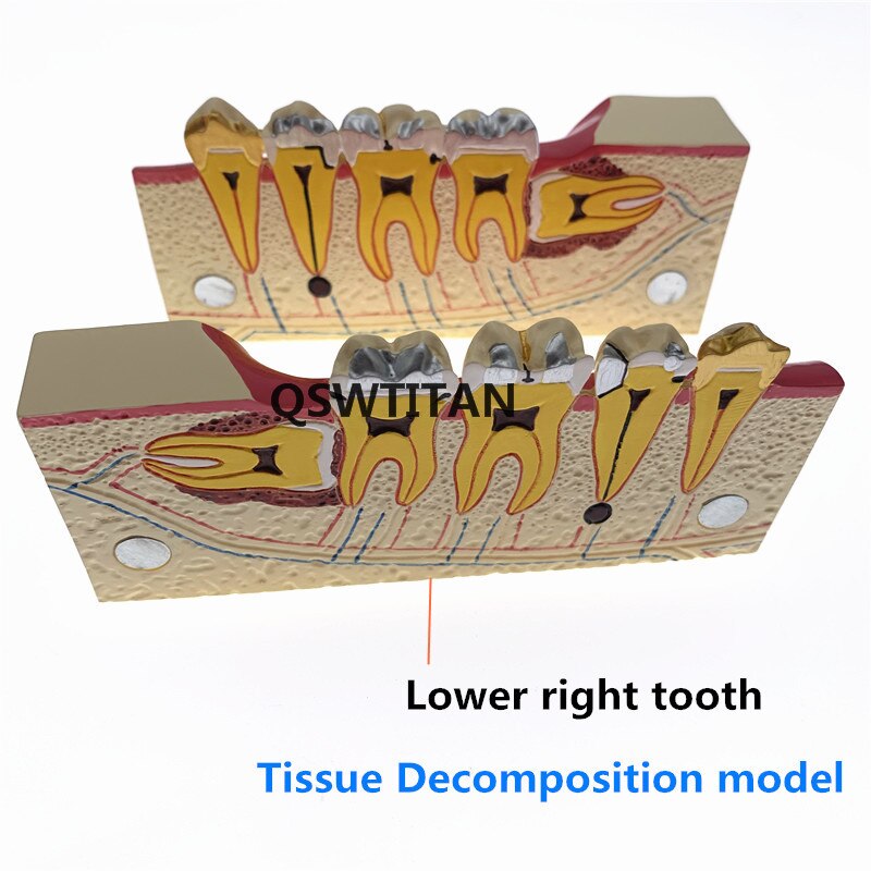 Dental Disease Teeth Anatomy Study Model Molar Cro... – Vicedeal