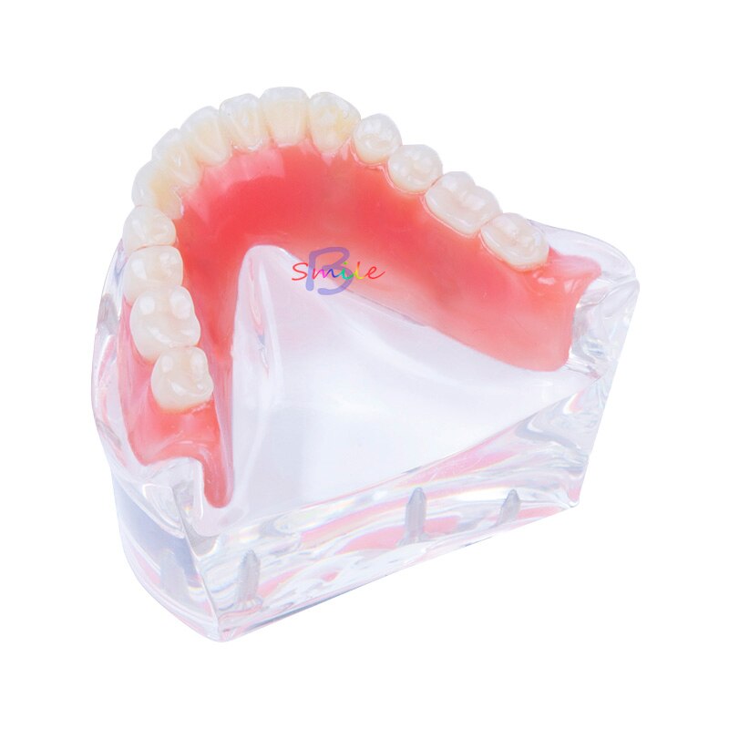1pcs Dental Teaching Study Overdenture Teeth Model... – Vicedeal