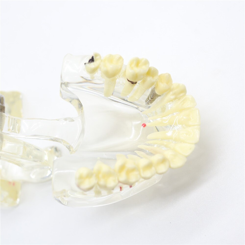 Dental Supplies Implant Disease Tooth Pathological... – Vicedeal