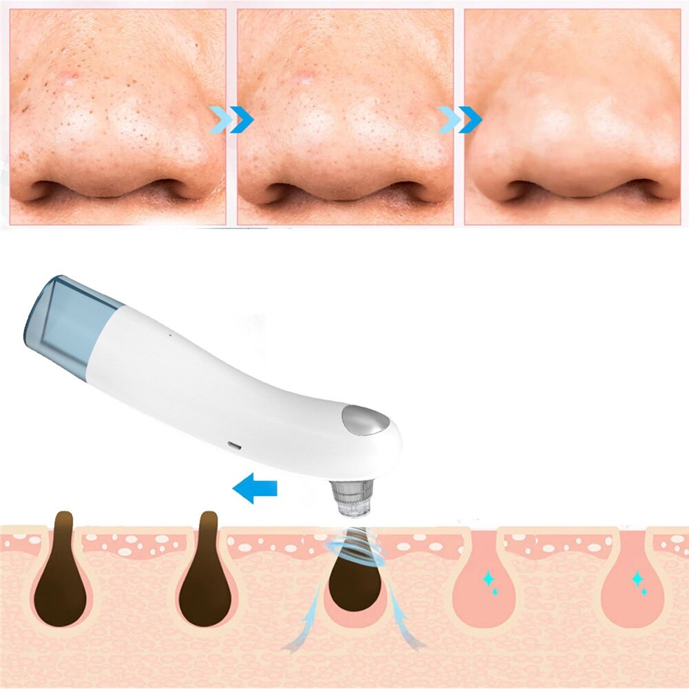 Small Bubbles Blackhead Remover Facial Pore Cleane... – Grandado