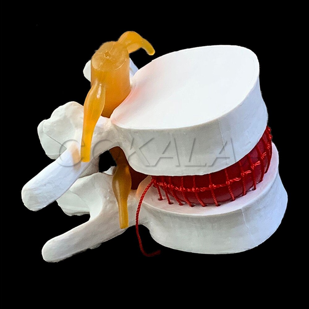Good 1pcs Human lumbar disc herniation model demon... – Grandado