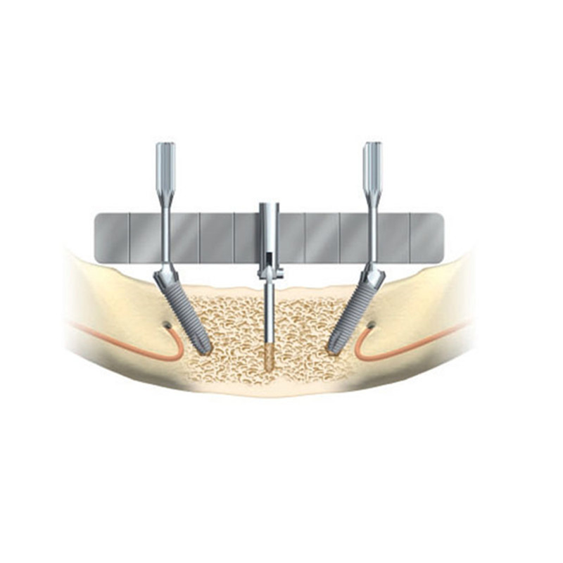 1Pcs Dental Implant Locating Guide Surgical Planti... – Vicedeal