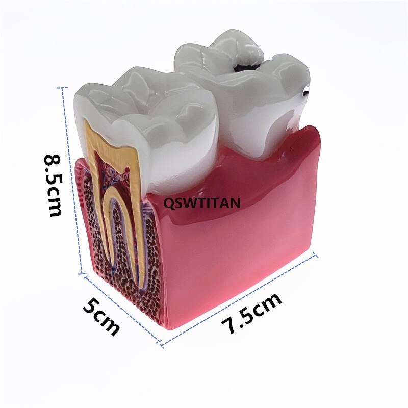 Dental Teeth Model Caries Comparation Study Models... – Vicedeal