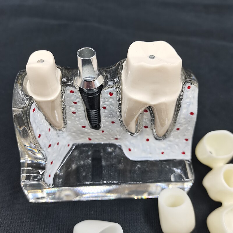Dental Implant Model 4 Times Analysis Crown Bridge... – Vicedeal
