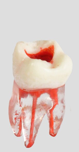 Dental Endodontic Root Canal Study Model RCT Demo ... – Vicedeal