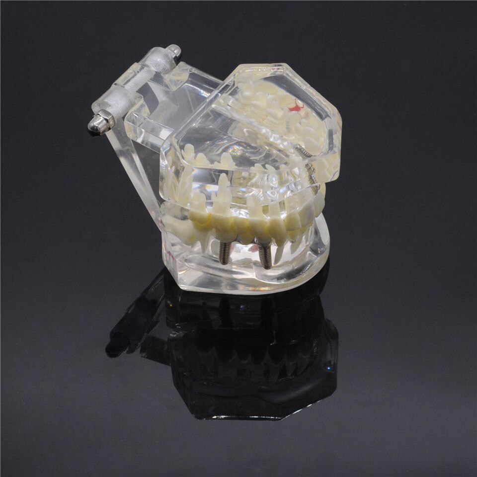 Dental Implant Detachable Model Study Model Classi... – Vicedeal