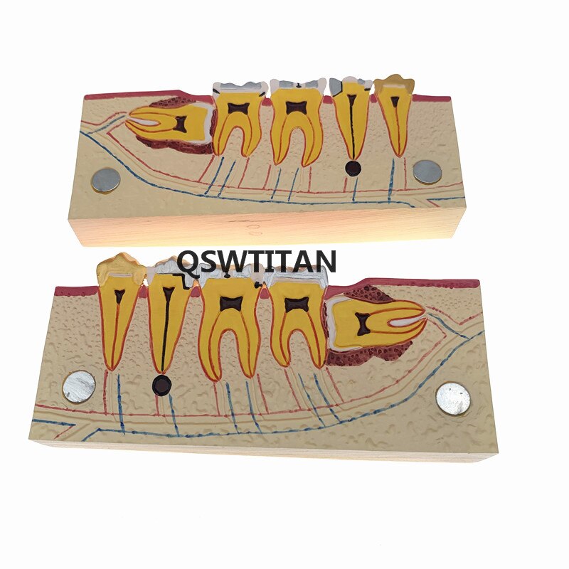 Dental Disease Teeth Anatomy Study Model Molar Cro... – Vicedeal