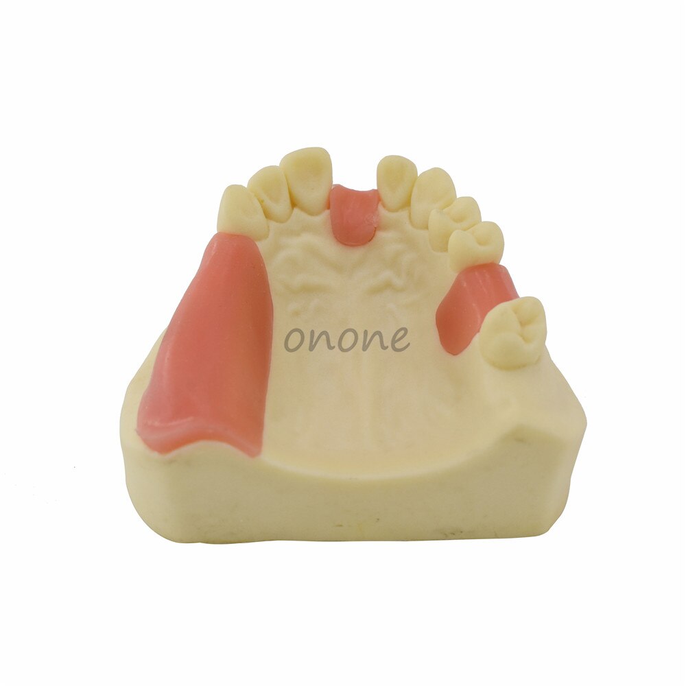 Maxillary Missing Tooth Model Bone Imitating Oral ... – Grandado