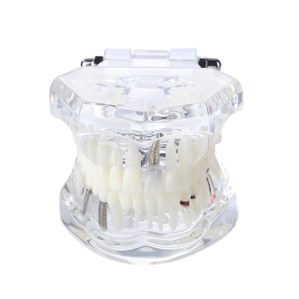 Transparent Disease Teeth Model Dental Implant Tee... – Grandado