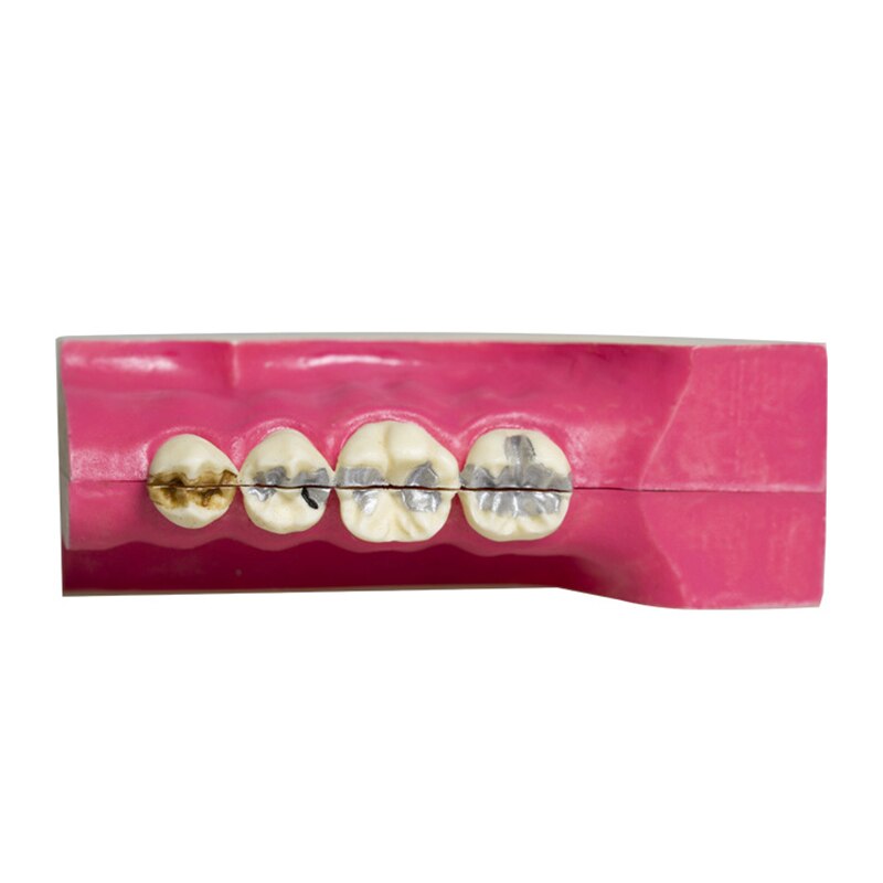 Right Lower Tooth Decomposition Model Molar Cross ... – Grandado