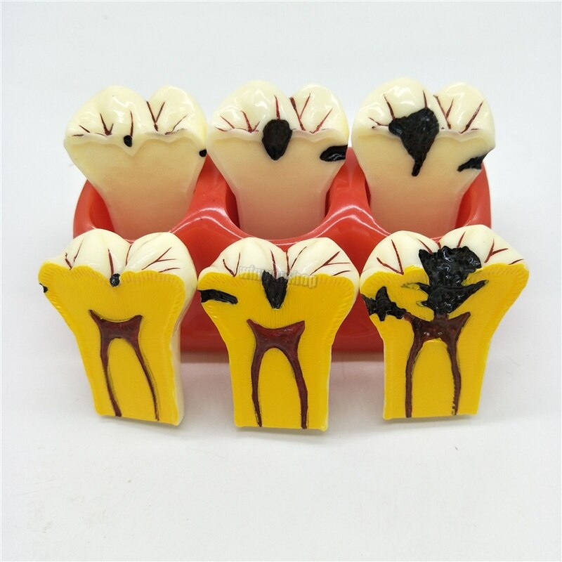 Dental Caries Decomposition Model Oral teaching Mo... – Grandado