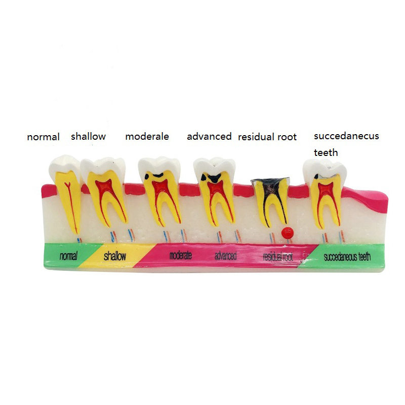 Dental Disease Teeth Model M4011 Demonstrates Prog... – Grandado
