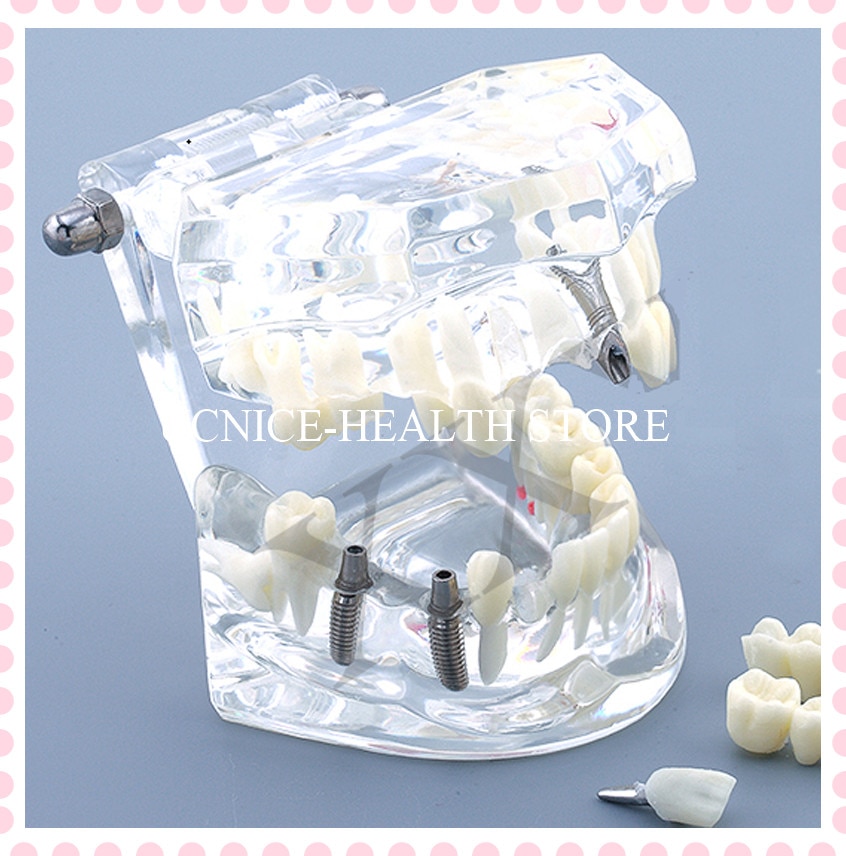 Dental Study Tooth Implant Pathological Teeth mode... – Grandado