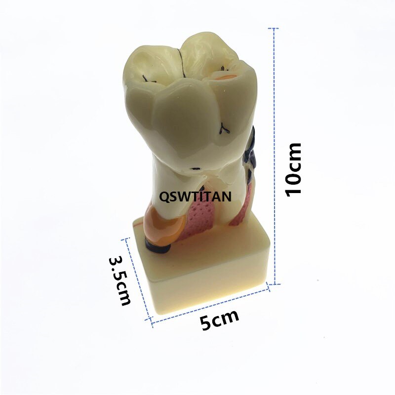Modèle de dents dentaires 4 fois, modèle de pathol... – Grandado