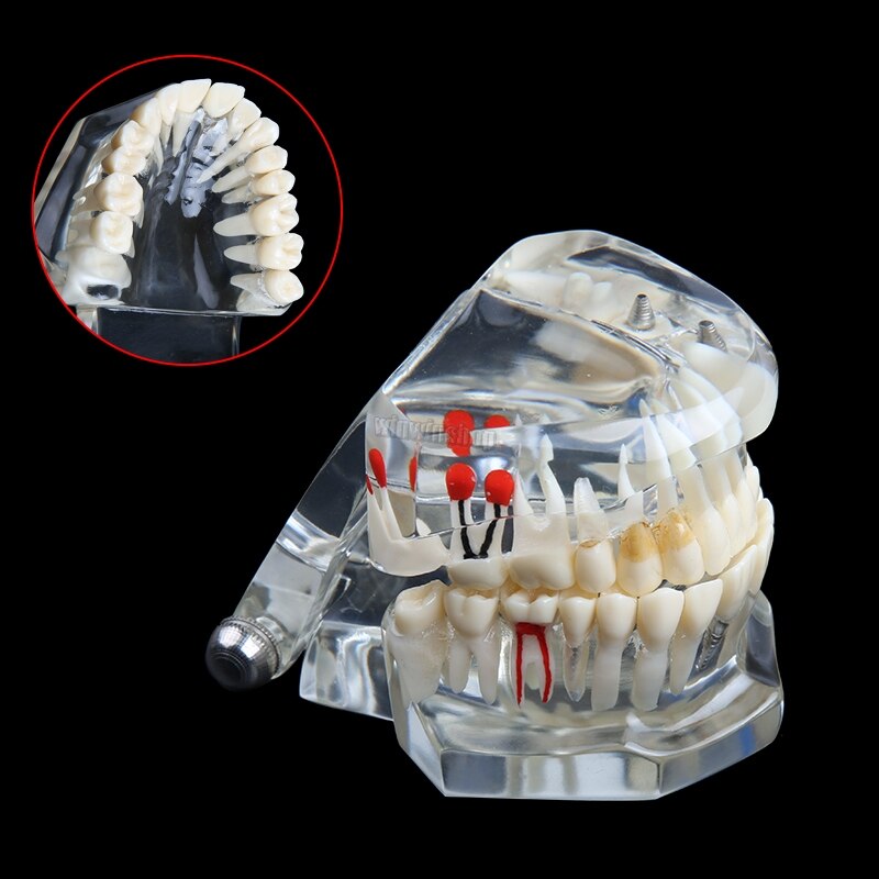 Dentist tooth human anatomy model classic repairab... – Grandado