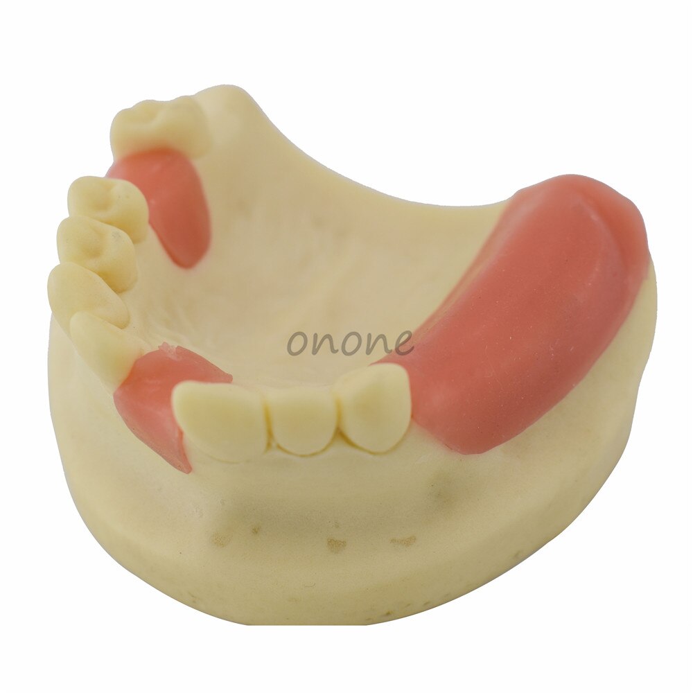 Maxillary Missing Tooth Model Bone Imitating Oral ... – Grandado