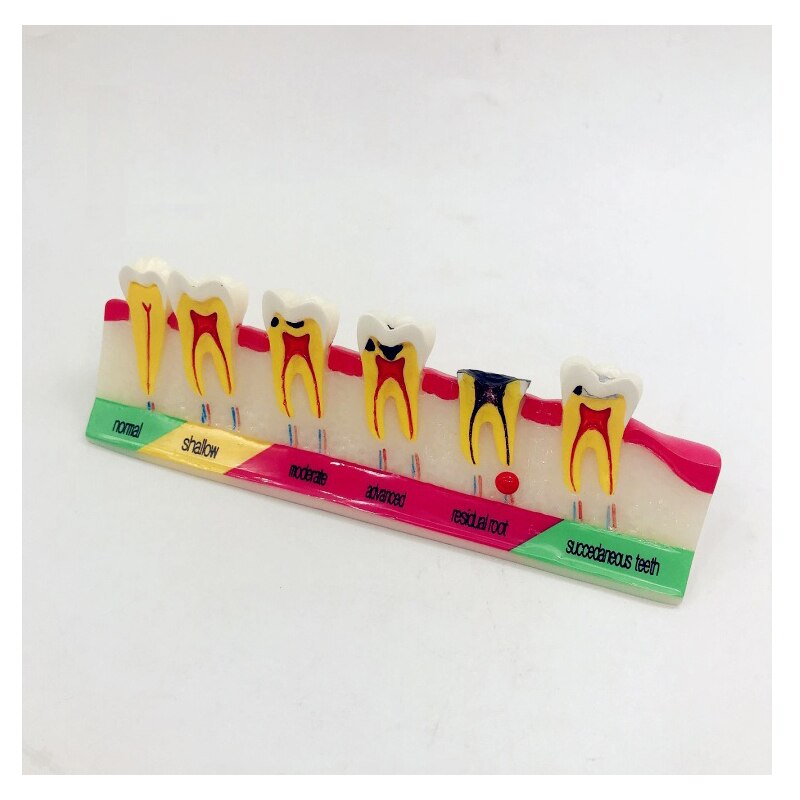 Dental Typodont Periodontal Disease Typodont Models Periodontics ...