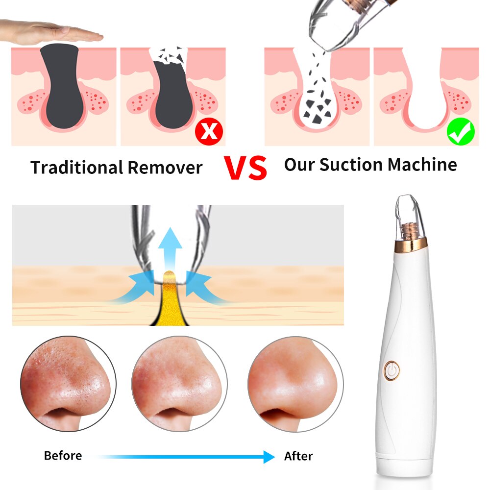Blackhead Remover Face Deep Nose Cleaner T Zone Po... – Grandado