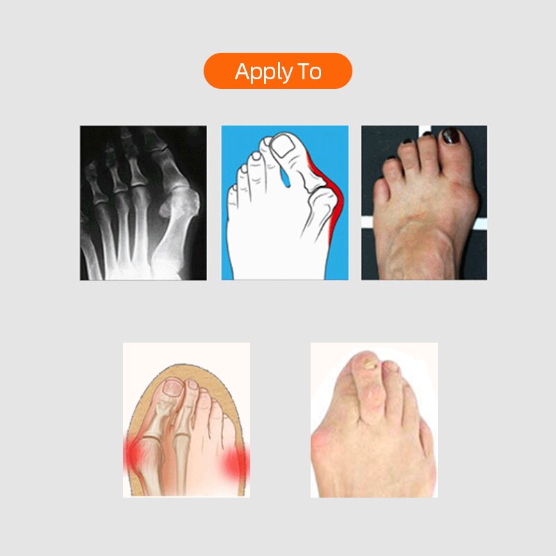 Big Toe Corrector Hallux Valgus Bunion Splint Corr... – Grandado