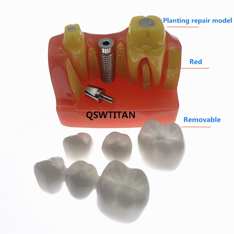 Dental 4 times planting Teeth model Analysis Crown... – Vicedeal