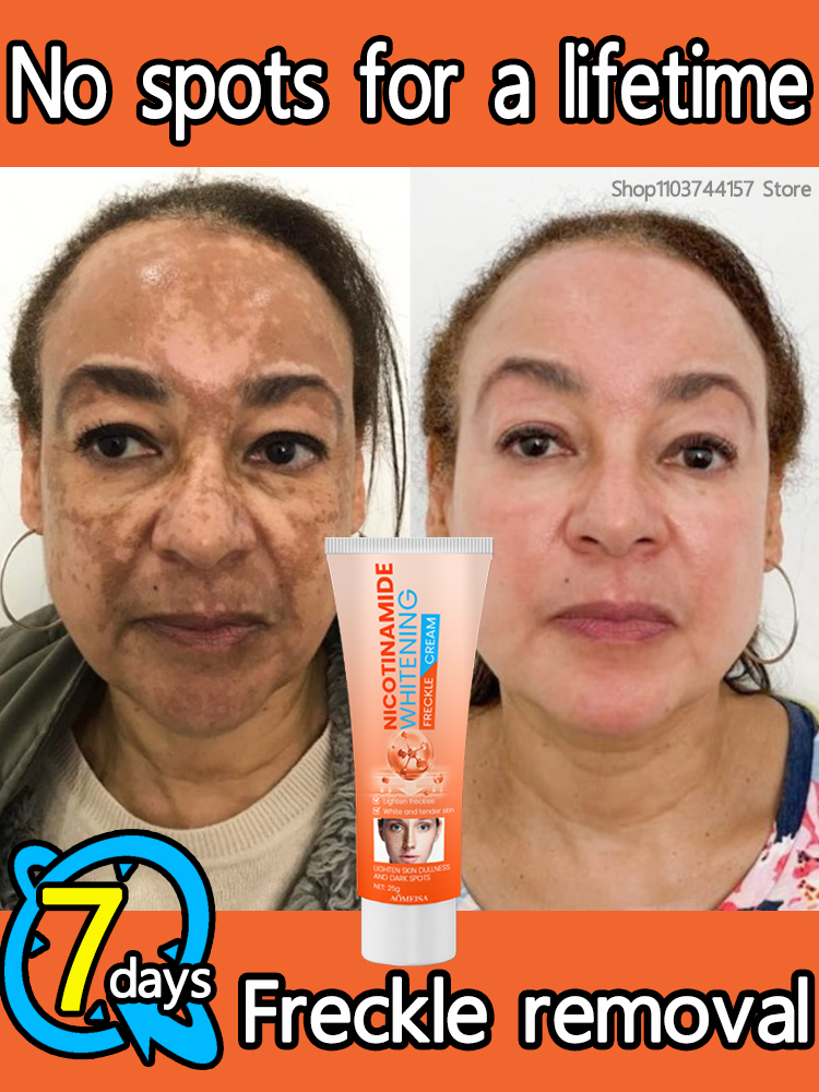 Klare dunkle Gesichts flecken, Chloasma, Alters fl... – Vicedeal